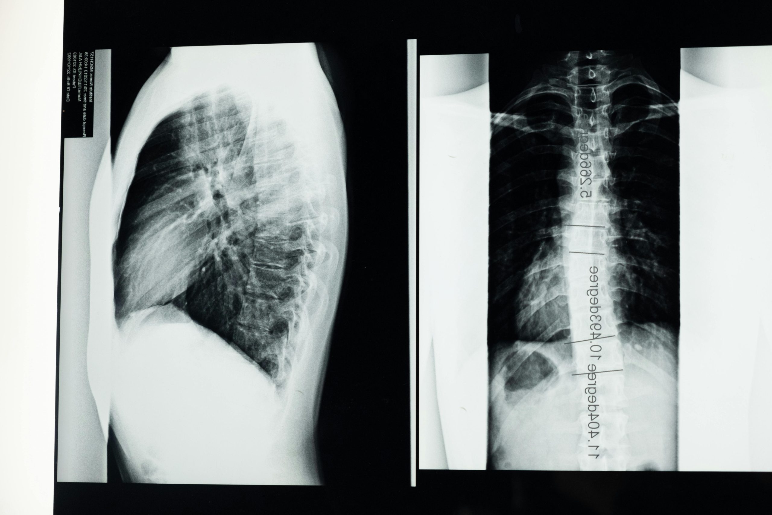 Can an X-Ray Show a Herniated Disc? | Orthobiologics Associates